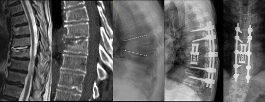 Entzündungen der Wirbelsäule | Wirbelsäulenzentrum | Leipziger Land ...