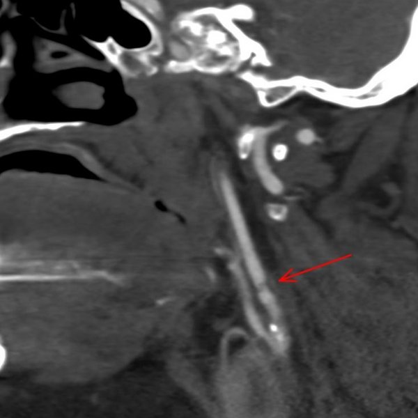 Carotisstenose: symptome und therapie – carotisstenose bilder – BHBY