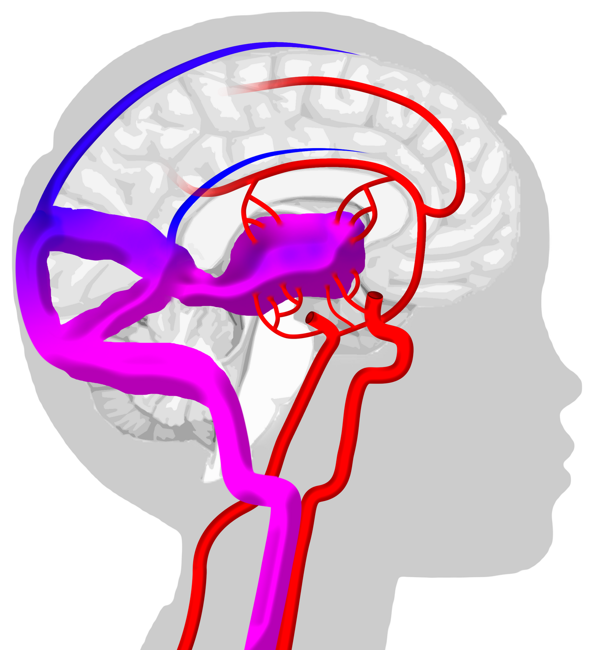 Vena Galeni Malformation