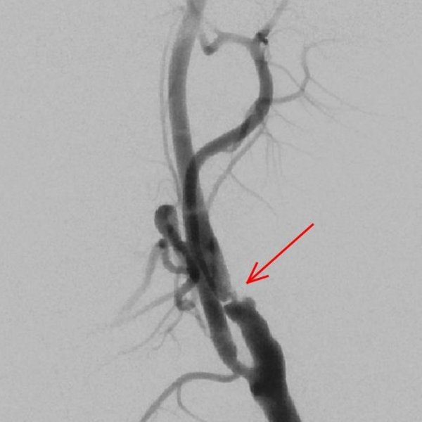 Carotisstenose: symptome und therapie – carotisstenose bilder – BHBY
