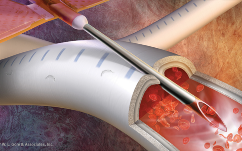 Endovaskuläre Therapie des Bauchaortenaneurysmas (BAA)